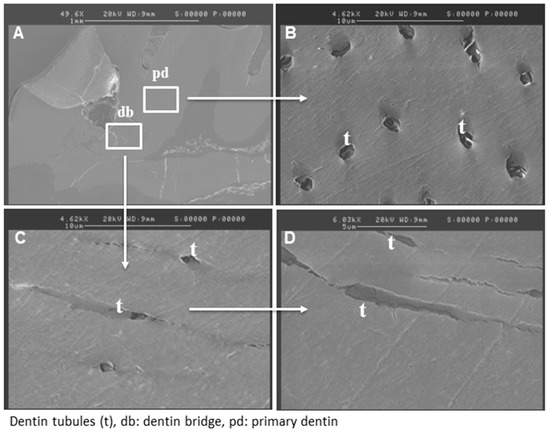 Reparative Mineralized Tissue Characterization after Direct Pulp ...