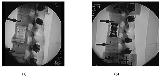 Biomechanical Study of a Novel, Expandable, Non-Metallic and ...