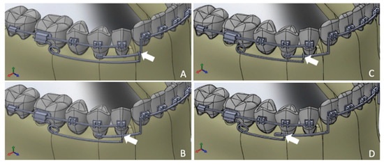 Pure Mandibular Incisor Intrusion: A Finite Element Study to Evaluate ...