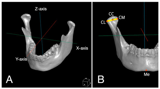 Materials | Free Full-Text | Evaluation of Effective Condyle ...