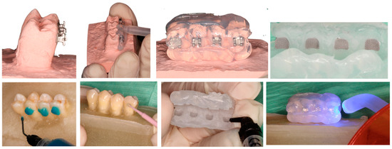 In Vitro Study of Shear Bond Strength in Direct and Indirect Bonding ...