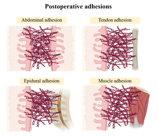 Biomaterials to Prevent Post-Operative Adhesion