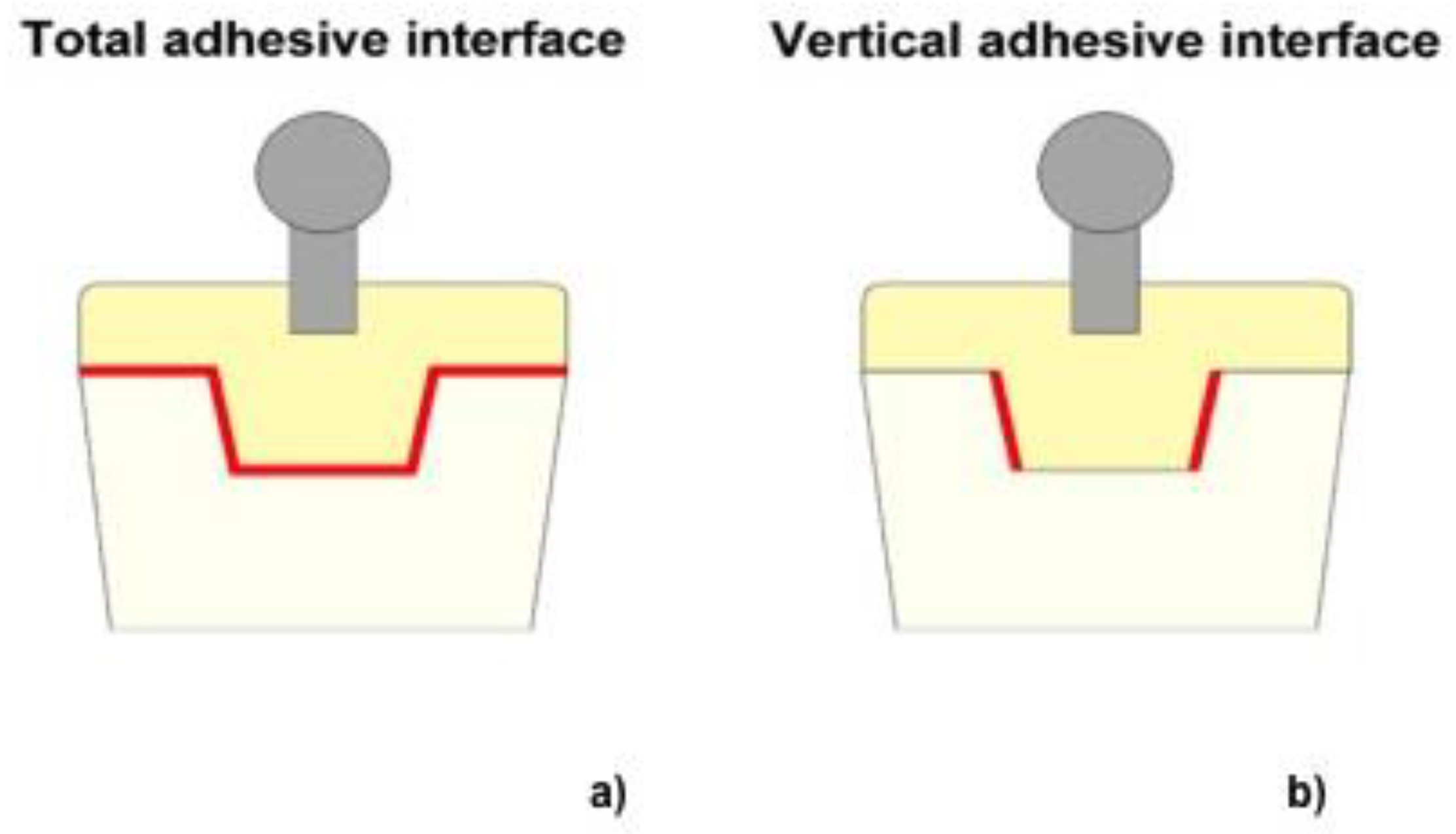 Tensile Strength and Failure Types of Direct and Indirect Resin ...
