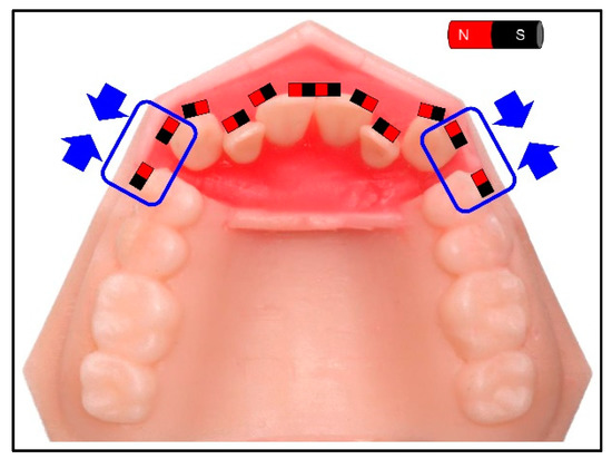 Effect of Magnet Position on Tipping and Bodily Tooth Movement in ...