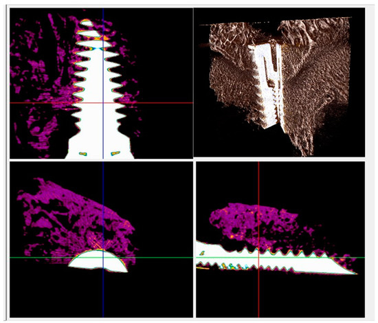 Titanium Implants Coated with a Bifunctional Molecule with Antimicrobic ...