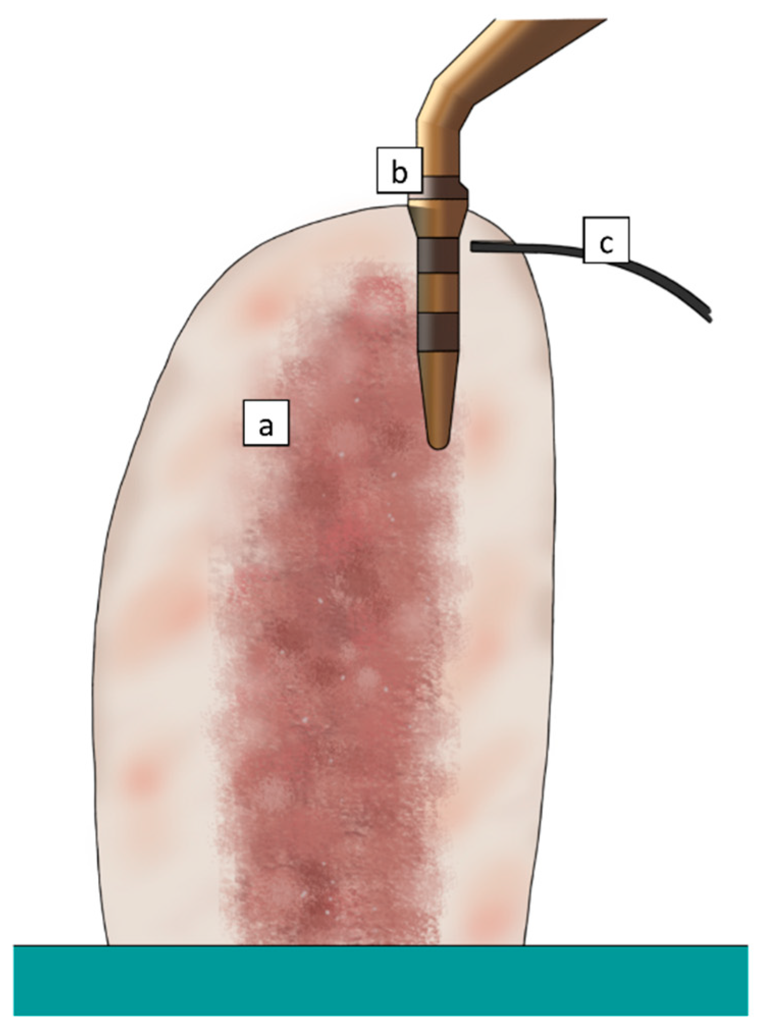 Piezoelectric Implant Site Preparation: Influence of Handpiece ...