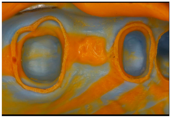 Influence of Vinyl Polysiloxane Impression Techniques on Marginal Fit ...