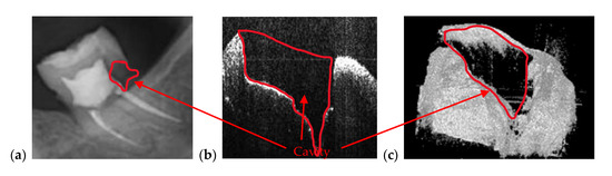 Dental Diagnosis and Treatment Assessments: Between X-rays Radiography ...