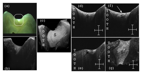 Dental Diagnosis and Treatment Assessments: Between X-rays Radiography ...