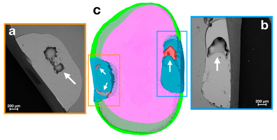 Microleakage Analysis of Different Bulk-Filling Techniques for Class II Restorations: µ-CT, SEM ...
