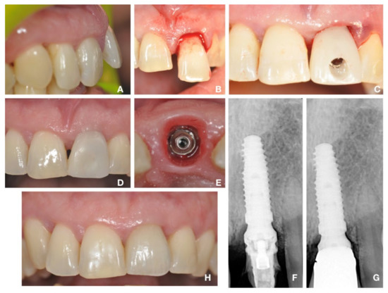 Biological Oriented Immediate Loading: A New Mathematical Implant ...
