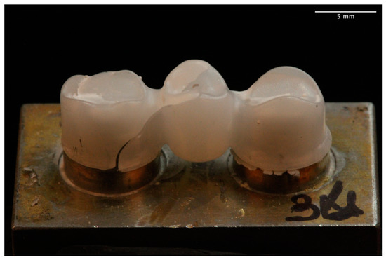 Materials | Free Full-Text | Fracture Load of Metal, Zirconia and ...