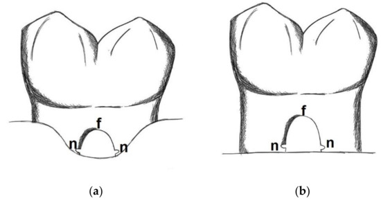 Platelet-Derived Growth Factor-Modulated Guided Tissue Regeneration ...