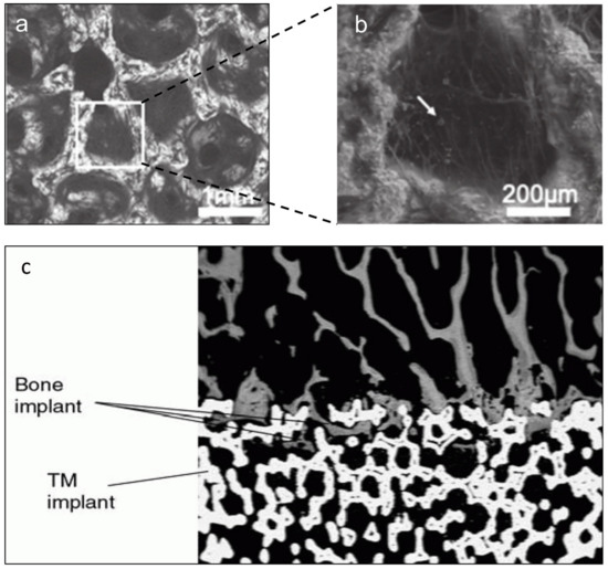 The Clinical Application of Porous Tantalum and Its New Development for ...