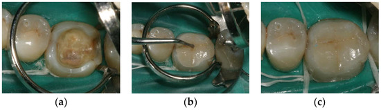 The One-Year In Vivo Comparison of Lithium Disilicate and Zirconium ...