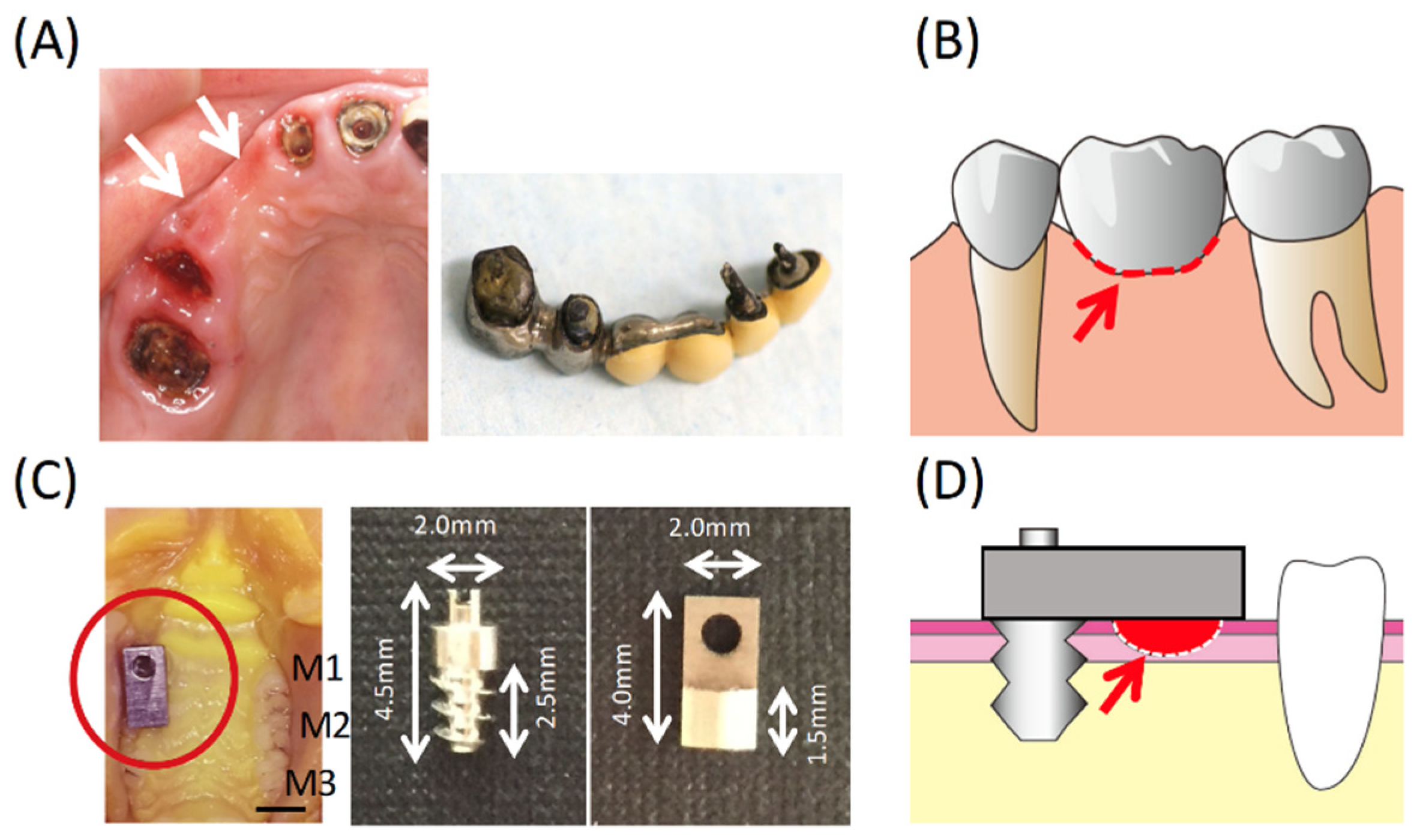 Assessment of the Soft-Tissue Seal at the Interface between the Base of ...