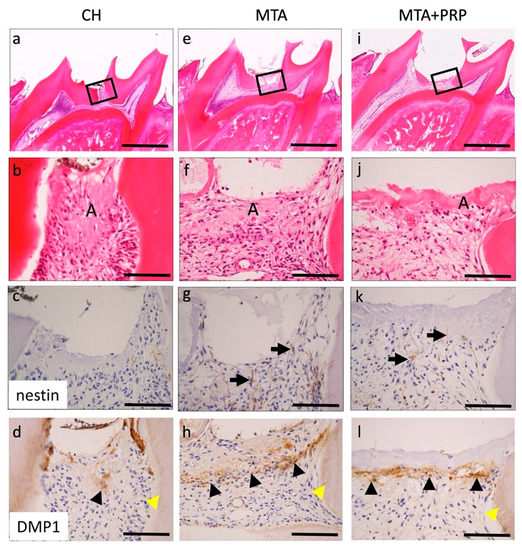 Mineral Trioxide Aggregate (MTA) Upregulates the Expression of DMP1 in ...