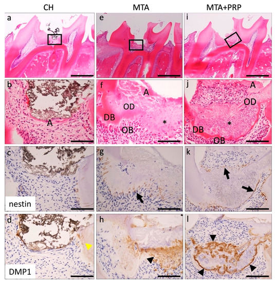 Mineral Trioxide Aggregate (MTA) Upregulates the Expression of DMP1 in ...