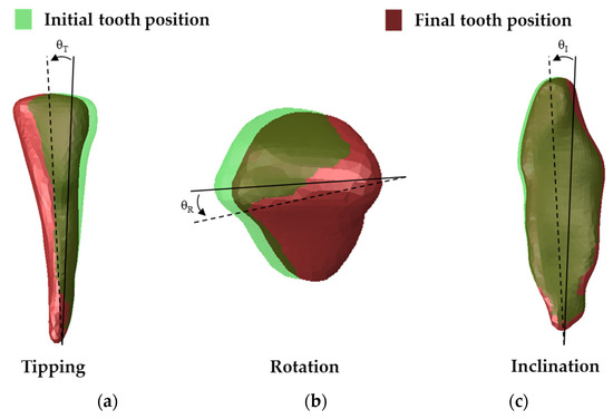Efficient Design of a Clear Aligner Attachment to Induce Bodily Tooth ...