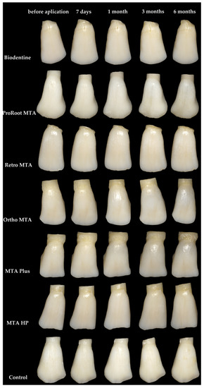 Vital Pulp Therapy in Aesthetic Zone-Identifying the Biomaterial That ...