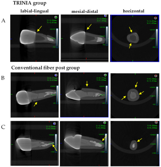 Fabricated CAD/CAM Post-Core Using Glass Fiber-Reinforced Resin Shows ...