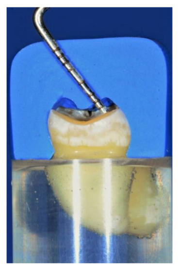 Fracture Resistance and Failure Mode of Mandibular Molar Restored by ...