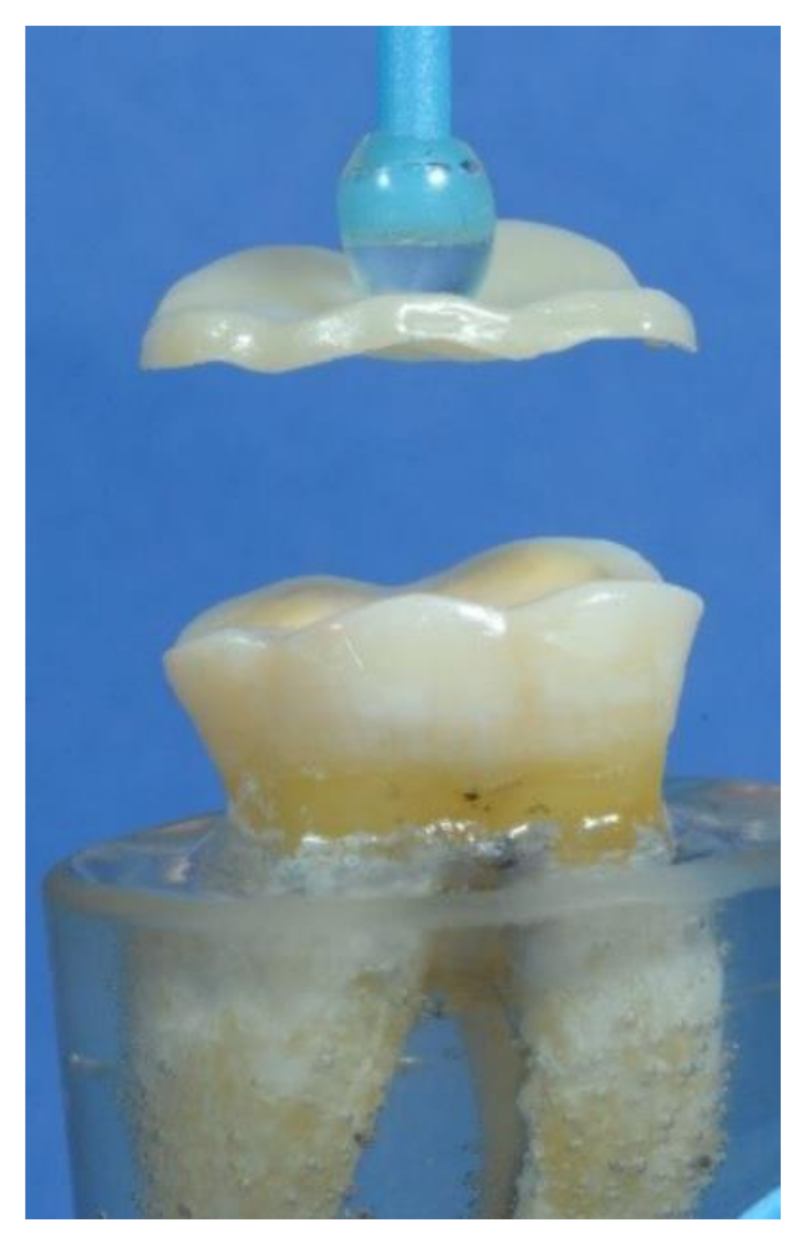 Fracture Resistance and Failure Mode of Mandibular Molar Restored by ...