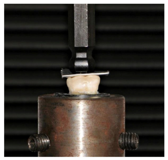 Fracture Resistance and Failure Mode of Mandibular Molar Restored by ...