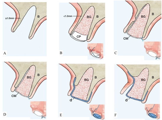 Materials | Free Full-Text | Classification Based on Extraction Socket ...