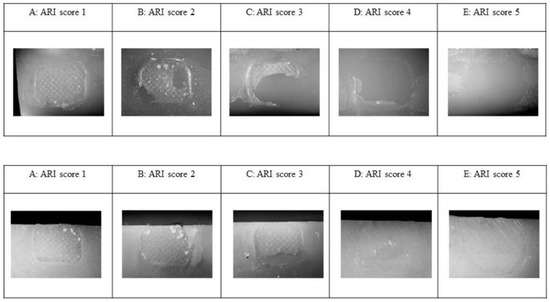 Bracket Bonding to All-Ceramic Materials with Universal Adhesives