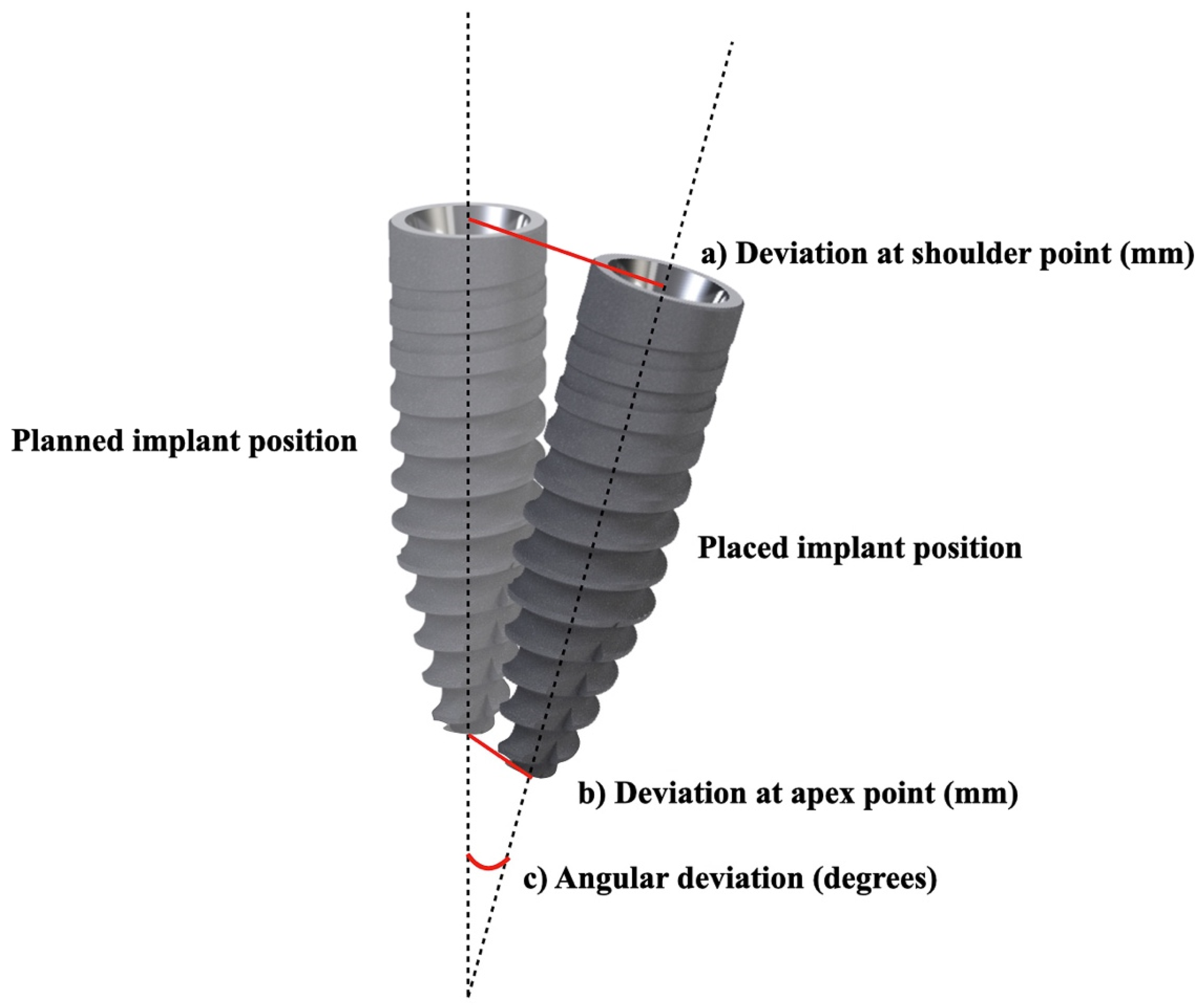 Accuracy of Computer-Assisted Flapless Implant Placement by Means of ...