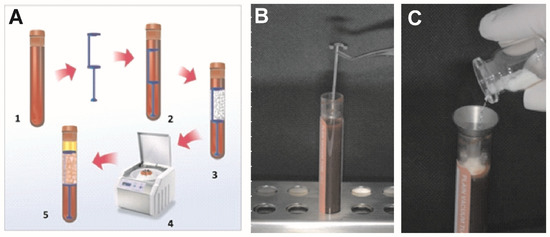 “Sticky Bone” Preparation Device: A Pilot Study on the Release of ...