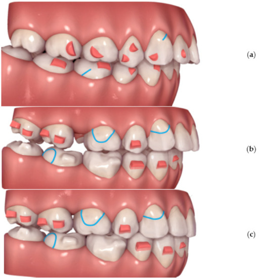 Utilization of a 3D Printed Orthodontic Distalizer for Tooth-Borne ...