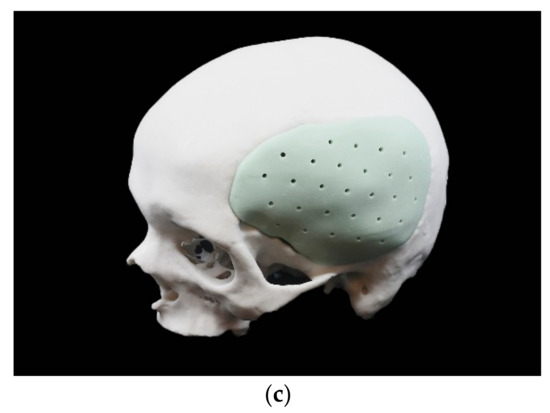 Biomechanical Evaluation of Patient-Specific Polymethylmethacrylate ...