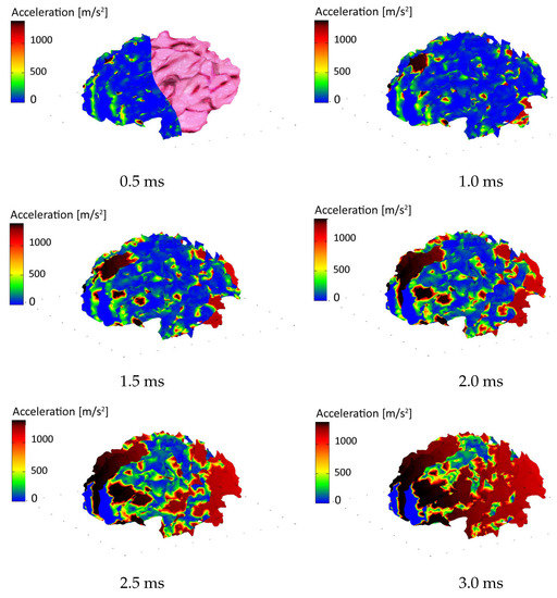 Effective Viscoplastic-Softening Model Suitable for Brain Impact Modelling