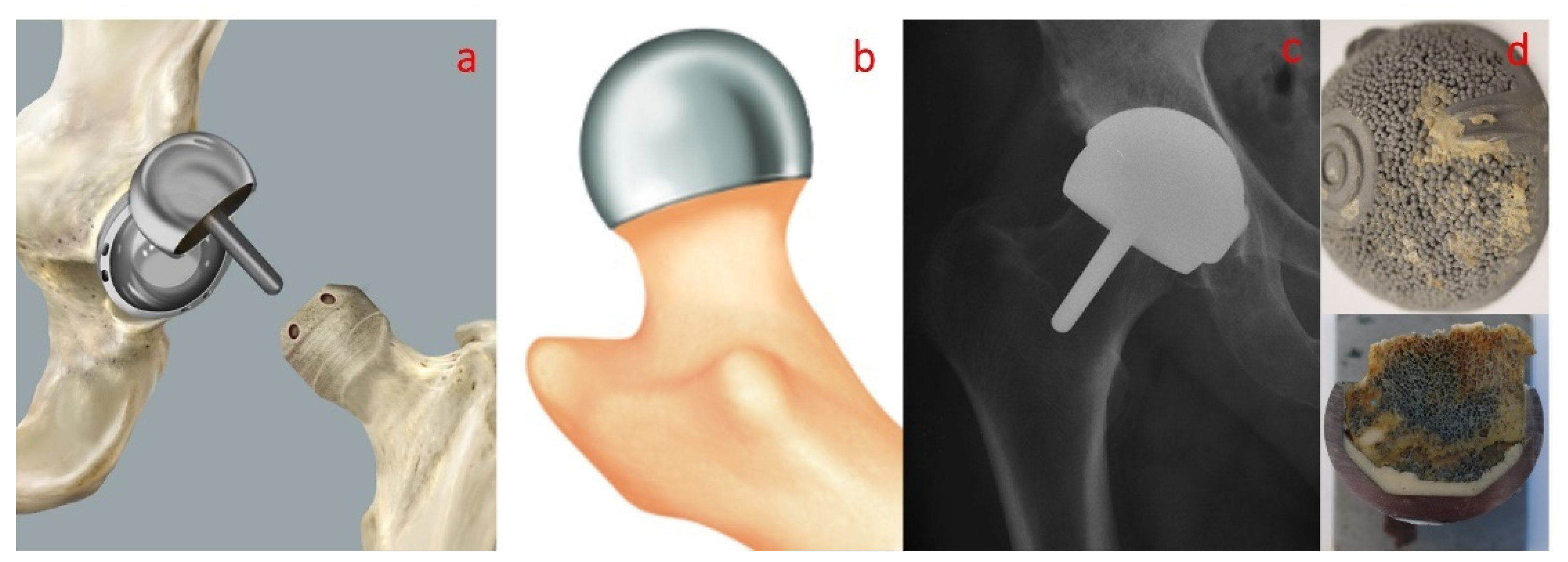 Bone Cements Used for Hip Prosthesis Fixation: The Influence of the Handling Procedures on ...