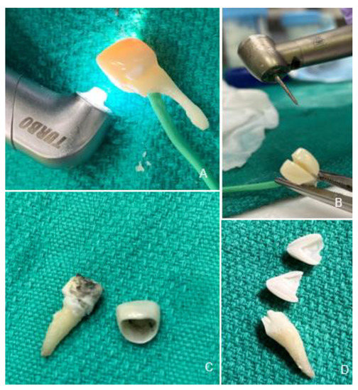 In Vitro Study of Laser-Assisted Prefabricated Ceramic Crown Debonding ...