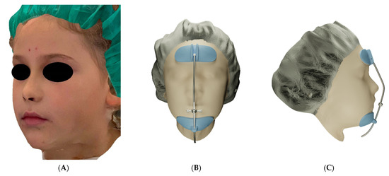 3D Printed Customized Facemask for Maxillary Protraction in the Early ...