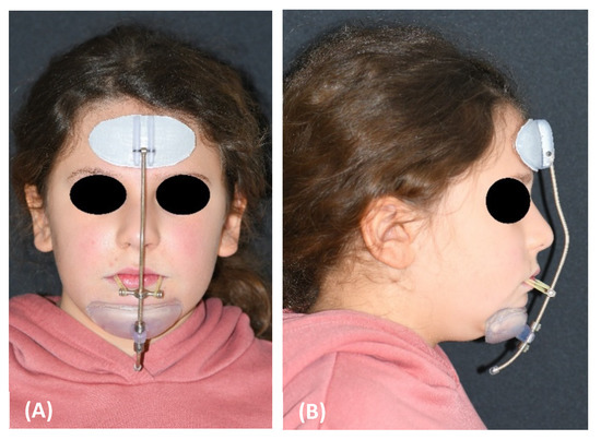 3D Printed Customized Facemask for Maxillary Protraction in the Early ...
