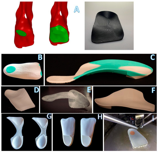 Foot Orthosis and Sensorized House Slipper by 3D Printing