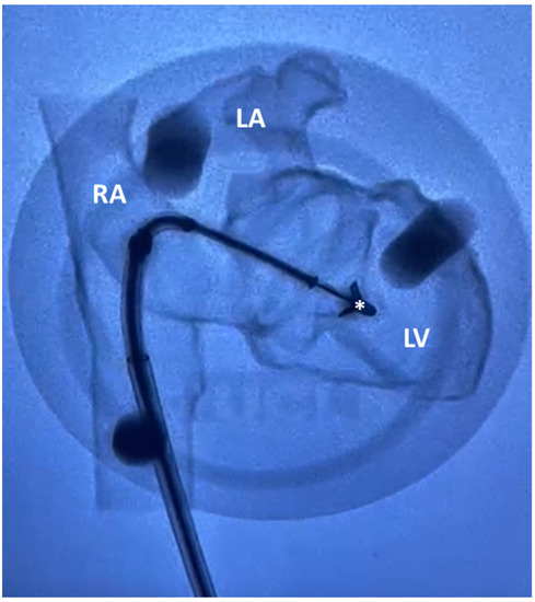 Demonstration of Use of a Novel 3D Printed Simulator for Mitral Valve ...