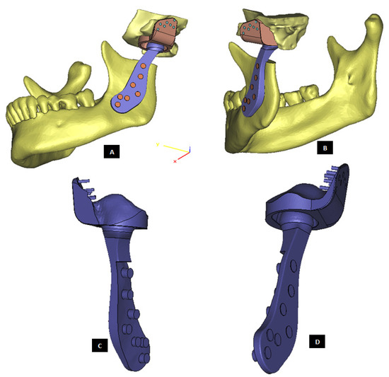 Design and Finite Element Analysis of Patient-Specific Total ...