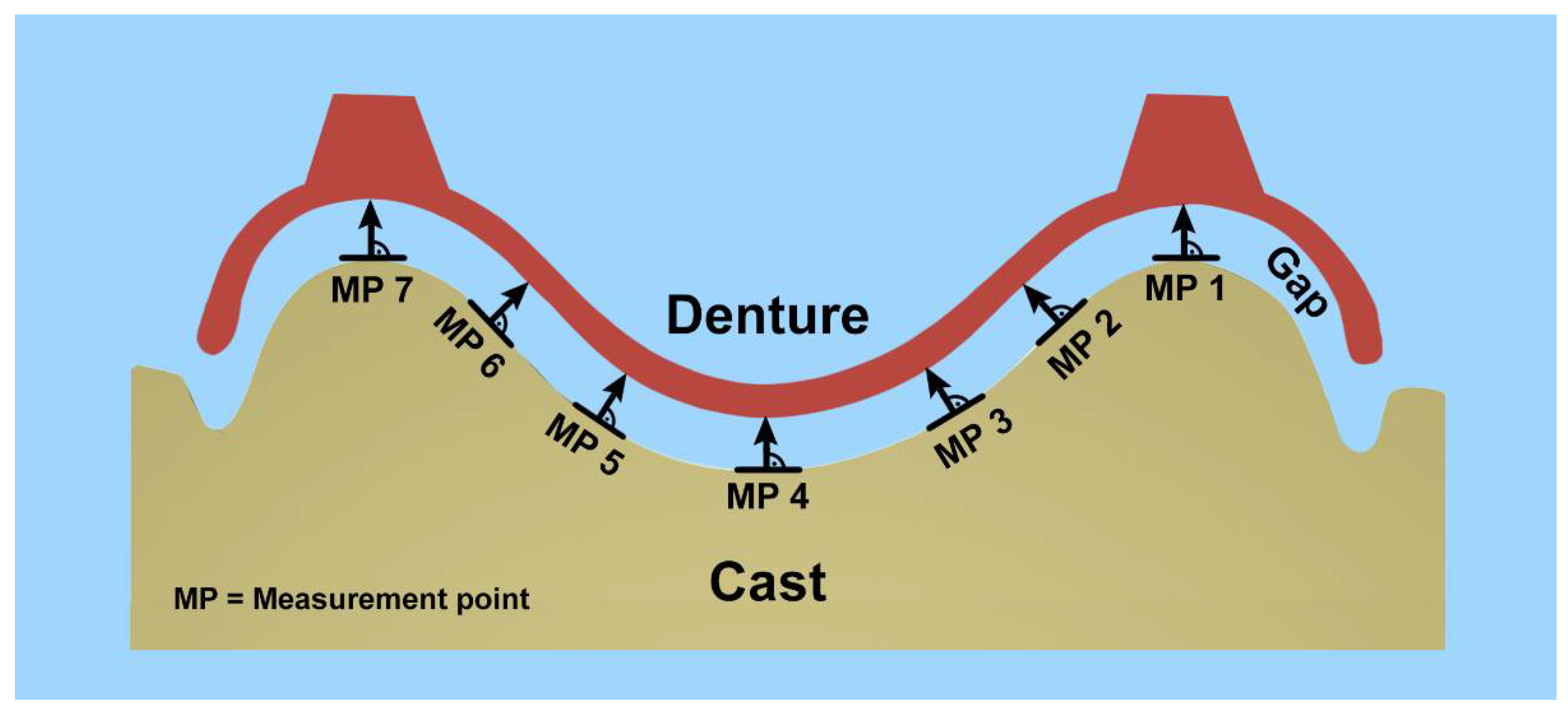 Misfit of Complete Maxillary Dentures’ Posterior Palatal Seal following ...