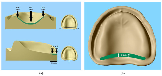Misfit of Complete Maxillary Dentures’ Posterior Palatal Seal following ...