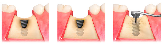 A Randomized Controlled Trial of Guided Bone Regeneration for Peri ...