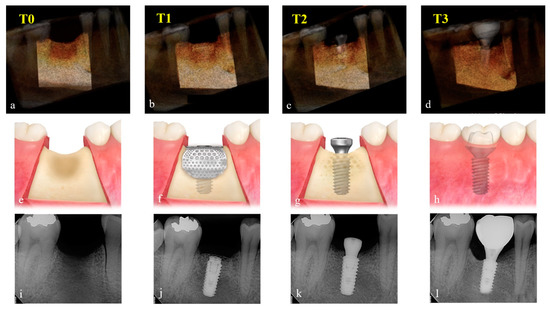 A Randomized Controlled Trial of Guided Bone Regeneration for Peri ...