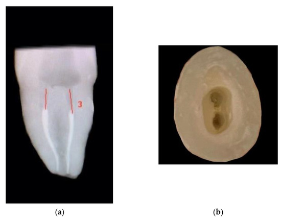 Impact of Ceramic Material and Preparation Design on Marginal Fit of ...