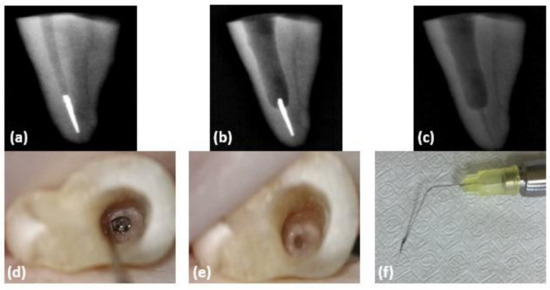 The Efficiency of the BTR-Pen System in Removing Different Types of ...