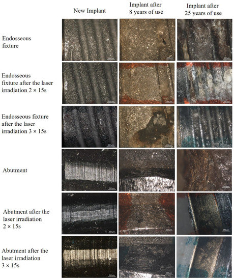 Analysis of the Microbiome on the Surface of Corroded Titanium Dental ...