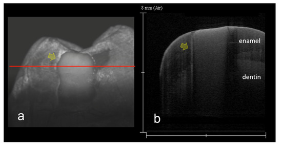 Evaluation of Incipient Enamel Caries at Smooth Tooth Surfaces Using SS-OCT
